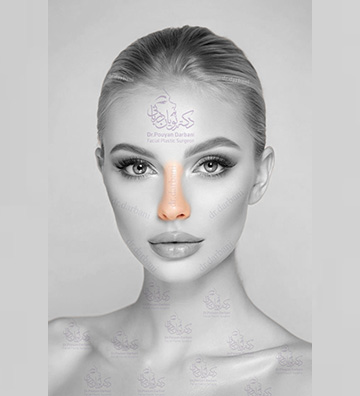 Revision Rhinoplasty | Expert Secondary Nose Surgery Guide