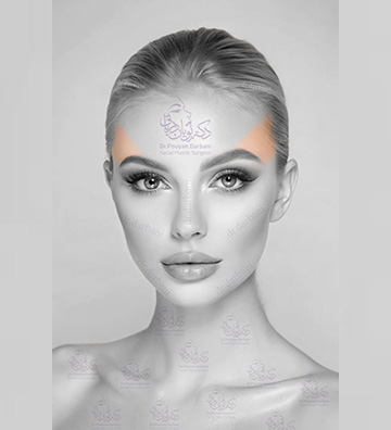 Brow lift and fox eye - dr darbani